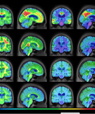 Over 41 million cases of dementia go undiagnosed across the globe ...